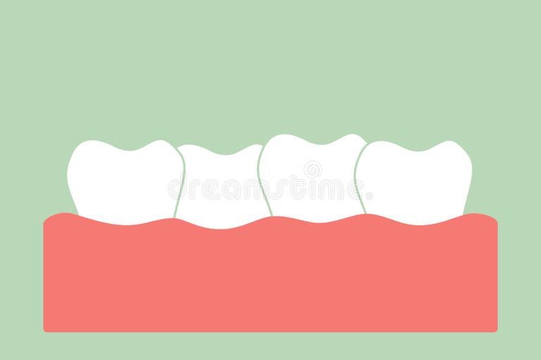 Crowding Teeth Malocclusion Stock Vector - Illustration of overcrowding ...