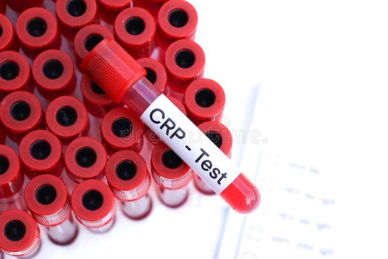 CRP Test To Look for Abnormalities from Blood Stock Photo - Image of ...