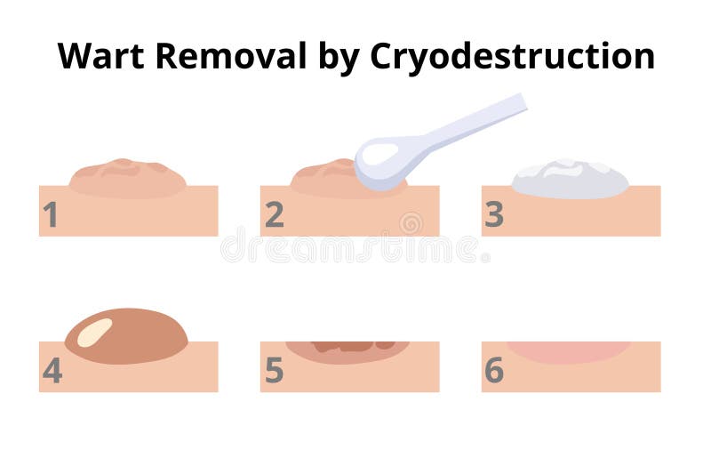 Dermatologist Removing Wart Using Cryodestruction Procedure in Six ...