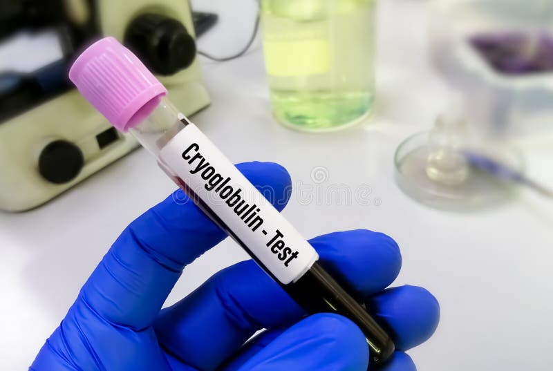 Cryoglobulin Test. stock photo. Image of infection, immunology - 278142926