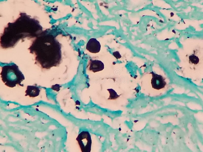 Cryptococcus Neoformans in Lung Tissue - Warthin Starry Silver Stain ...