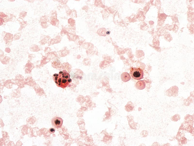 Cryptococcus in Peripheral Blood Smear. Gram Stain. Stock Image - Image ...
