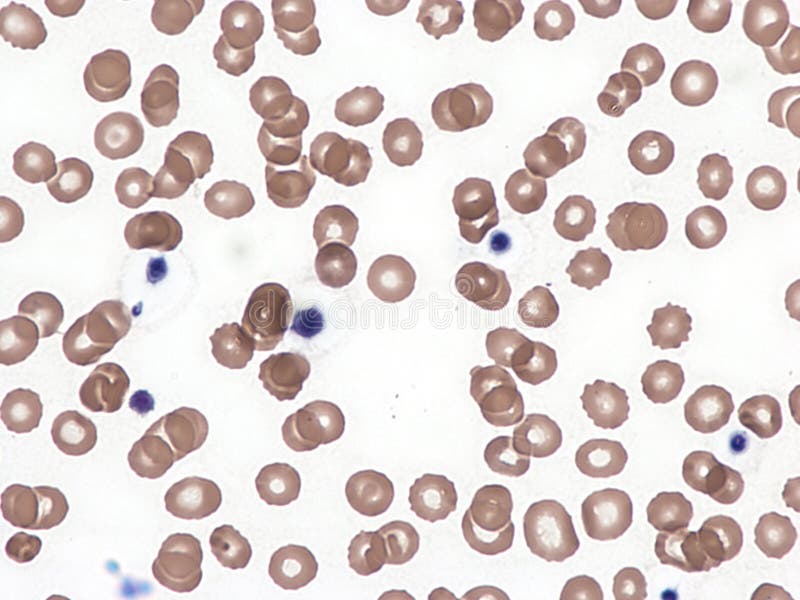 Cryptococcus in Peripheral Blood Smear. Stock Image - Image of wright ...