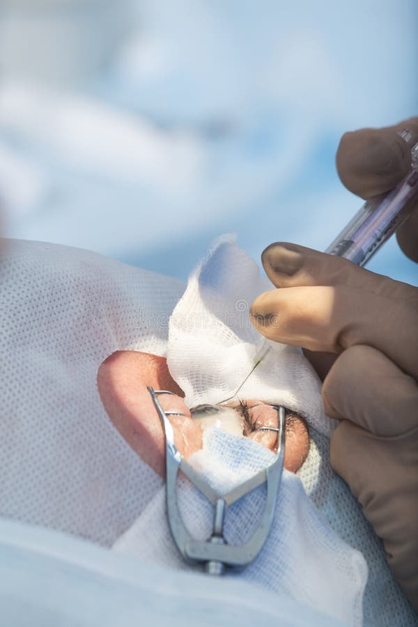 Crystalline Lens Replaceable Surgical Method Stock Photo - Image of ...