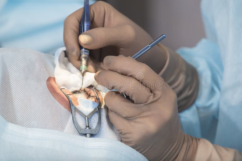 Crystalline Lens Replaceable Surgical Method Stock Photo - Image of ...