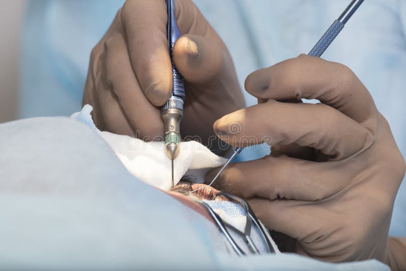 Crystalline Lens Replaceable Surgical Method Stock Photo - Image of ...