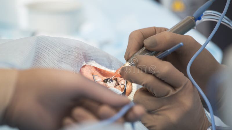 Crystalline Lens Replaceable Surgical Method Stock Photo - Image of ...