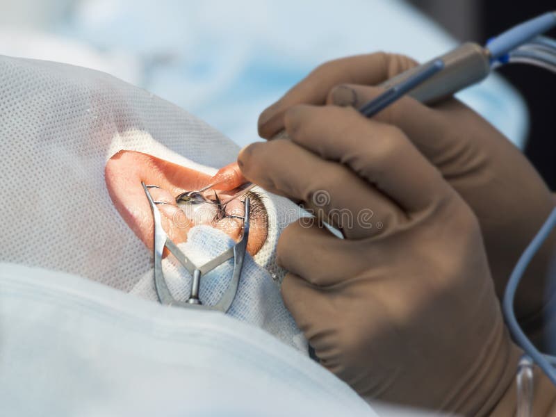 Crystalline Lens Replaceable Surgical Method Stock Image - Image of ...