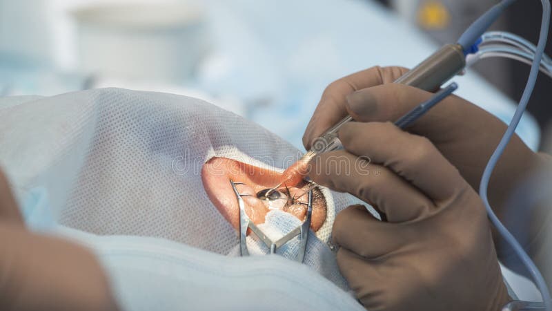 Crystalline Lens Replaceable Surgical Method Stock Photo - Image of ...