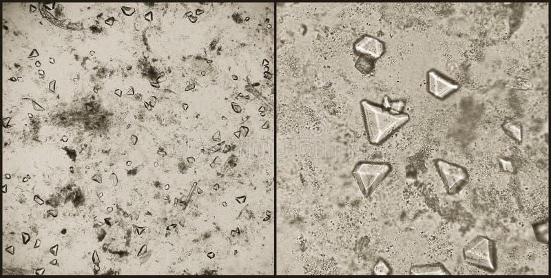 Sediment of human urine stock photo. Image of painful - 88266090