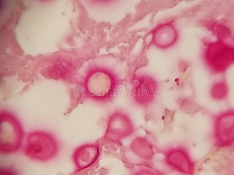 Crytpococcus Neoformans Stained with Mucicarmine in Lung Biopsy Stock ...