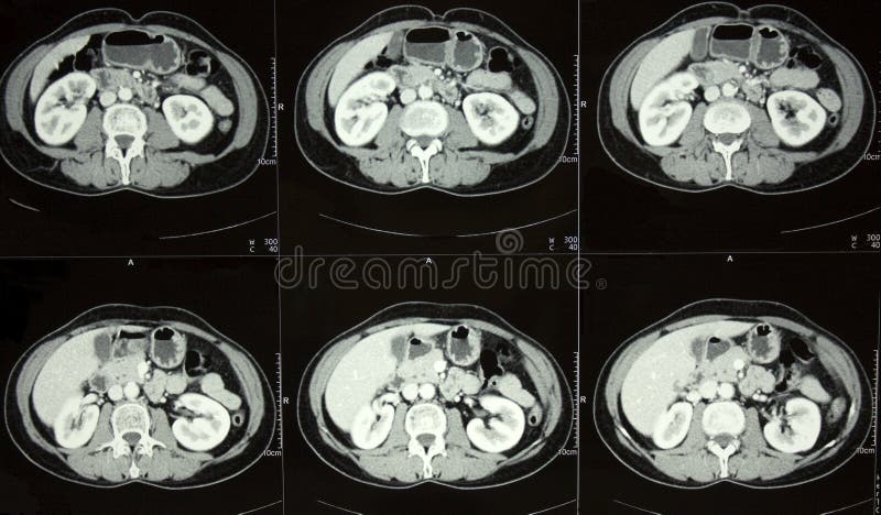 CT of Abdomen, Liver, Spleen, Kidneys Stock Image - Image of computed ...