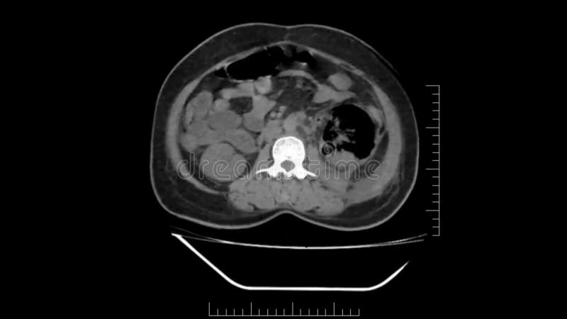 CT Abdomen Scan Thin NCCT Kub Sequence 3 Stock Footage - Video of check, anatomy: 299793222