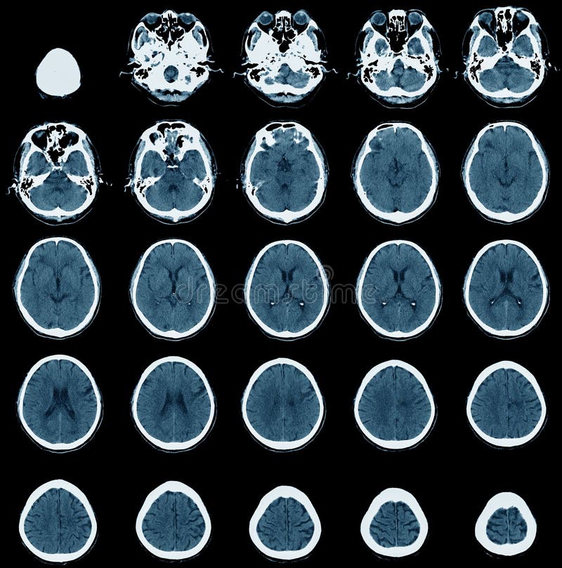 CT Aftasten Met 3D Beeld Van Normale Menselijke Schedel En Cervicale ...