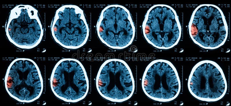 CT Aftasten Van Een Grote Intracerebral Hemorrhge Van De Hersenen Stock ...
