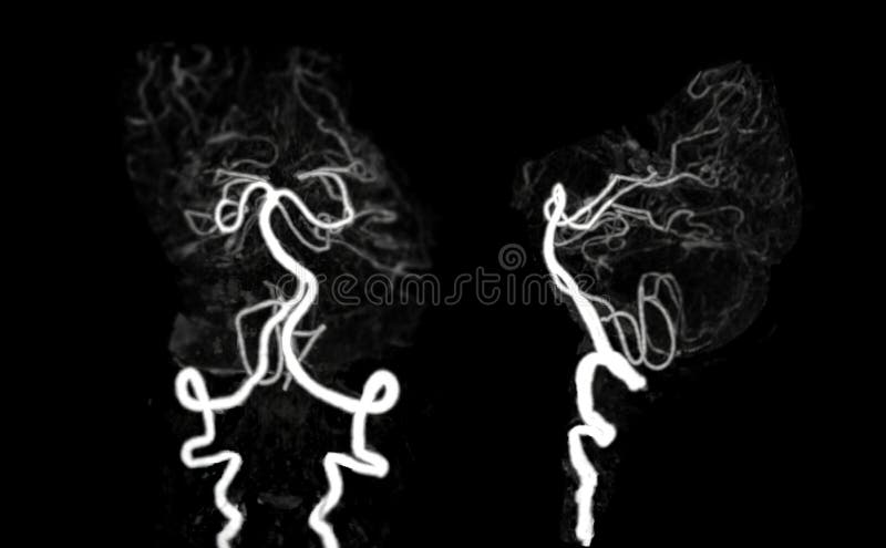 CT Angiography of the Brain or CTA Brain Showing Noraml Cerebral Artery ... CT Angiography of the Brain or CTA Brain Showing Noraml Cerebral Artery ...