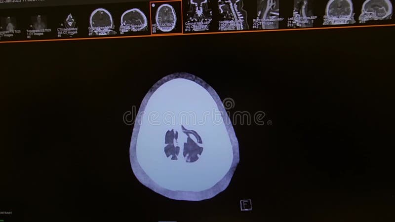 CT Brain Angiography - Transverse Image in Black, White Stock Video ...