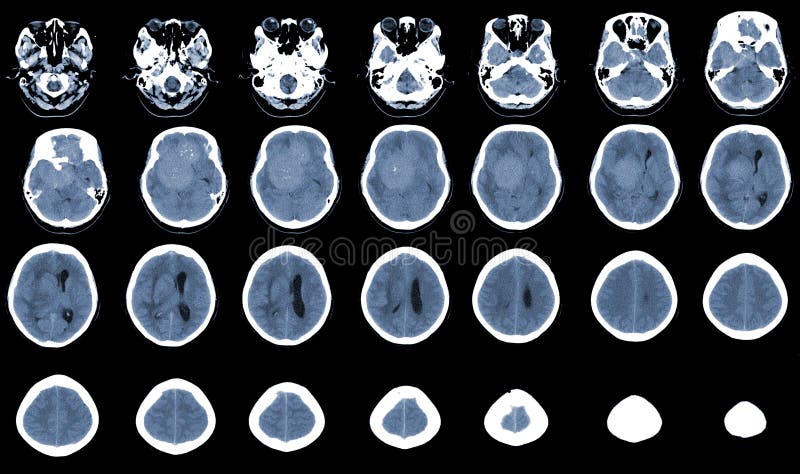 Ct Brain Axial Scans Hyperdense Mass With Homogeneous And Mild Perilesional Brain Edema At The