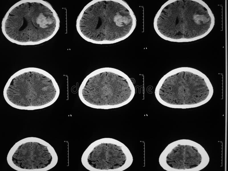 CT-Brain stock photo. Image of monochrome, brain, ctbrain - 106140556