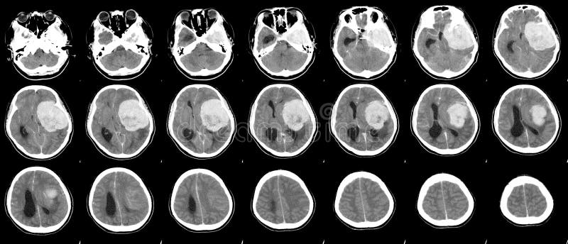 Ct Brain History Headache Finding A 7 Cm Extra Axial Mass With Stong Enhancement And Mass