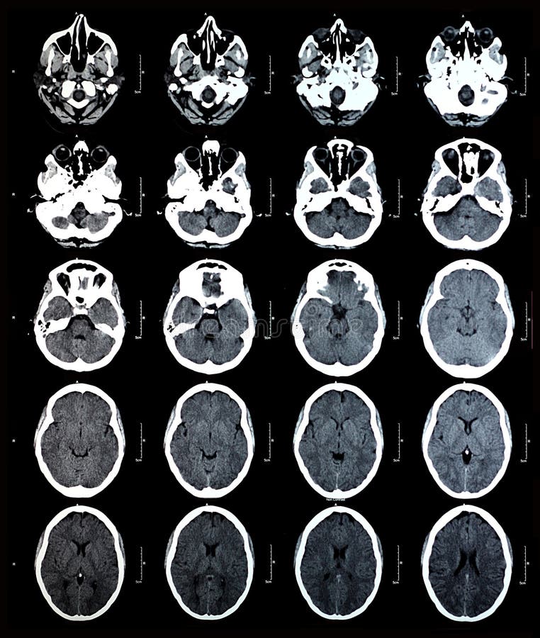 CT Scan of Brain : Show Normal Human S Brain ( CAT Scan ) Stock Photo ...