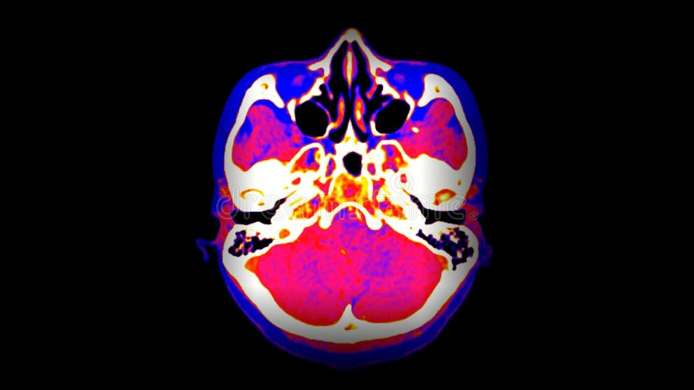 CT Brain Perfusion or CT Scan Image of the Brain Axial View Stock Photo ...