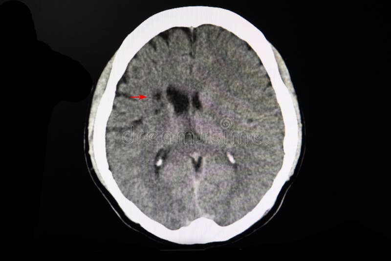 CT Brain of a Stroke Patient Stock Image - Image of infarct, atrophy ...