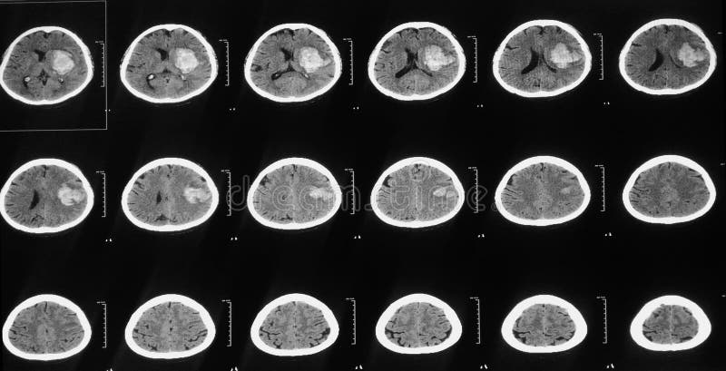 CT-Brain stock image. Image of illness, neurosurgery - 106140485