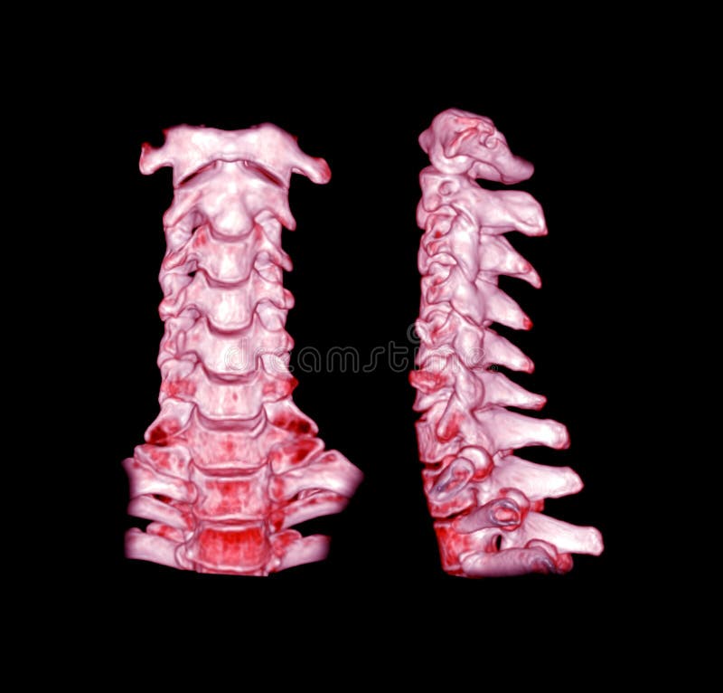 CT C-Spine or Cervical Spine 3D Rendering Image Stock Illustration ...