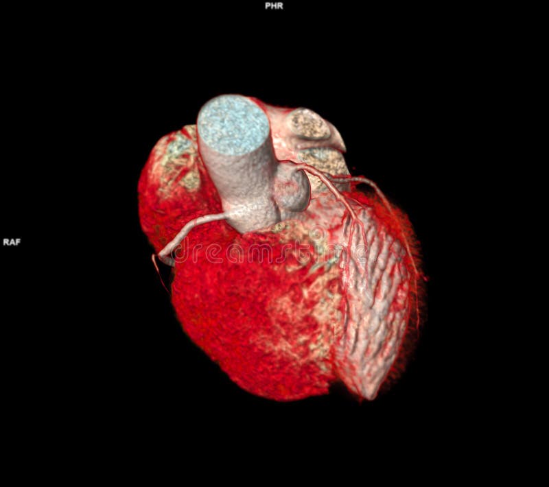 CT Cardiac 3D or CTA Coronary Artery Stock Illustration - Illustration ...