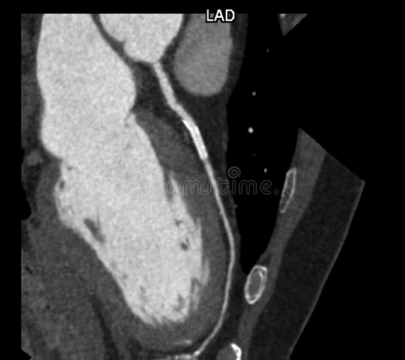 CT Cardiac 3D or CTA Coronary Artery Stock Illustration - Illustration ...