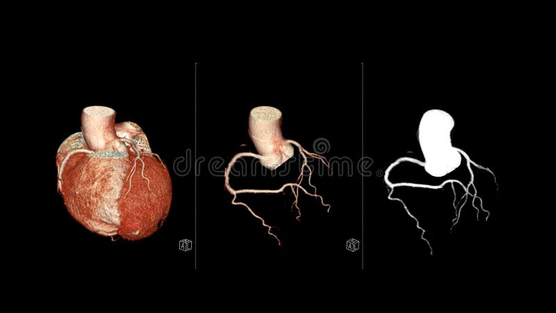 CT Cardiac 3D or CTA Coronary Artery Stock Illustration - Illustration ...