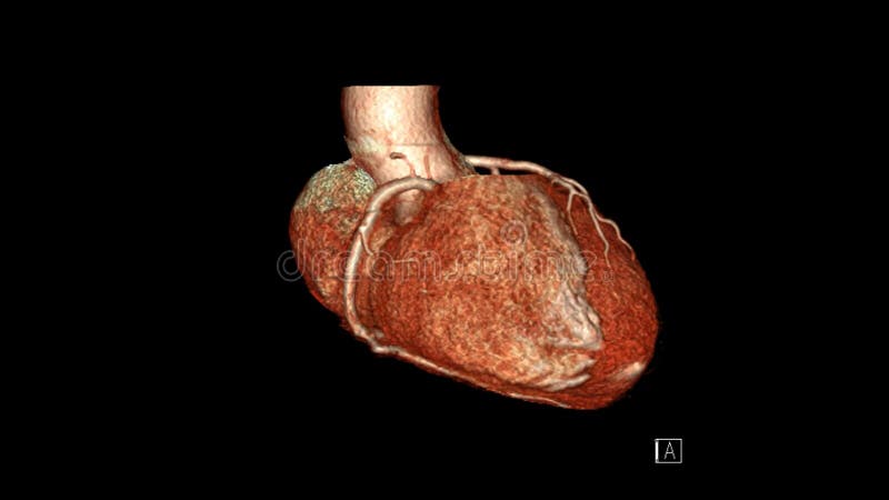 CT Cardiac 3D or CTA Coronary Artery Stock Illustration - Illustration ...