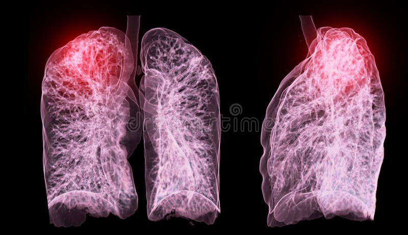 A CT Chest 3D Scan Displaying a Lesion at the Right Upper Lobe Offers a ...