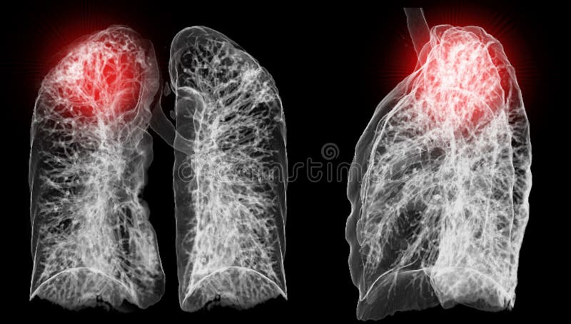 A CT Chest 3D Scan Displaying a Lesion at the Right Upper Lobe Offers a ...