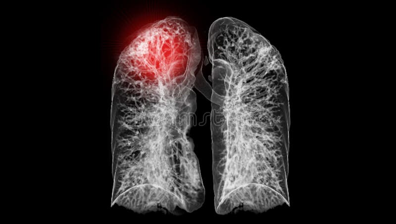 A CT Chest 3D Scan Displaying a Lesion at the Right Upper Lobe Offers a ...