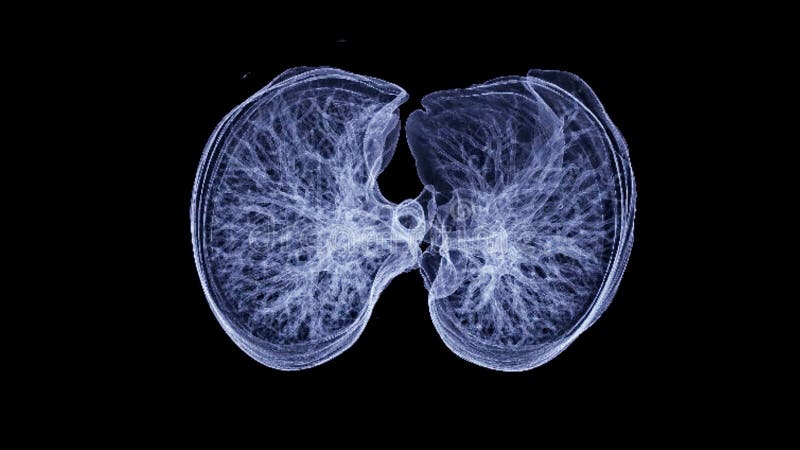 CT Chest or CT Lung 3d Rendering Image with Blue Color Showing Trachea ...