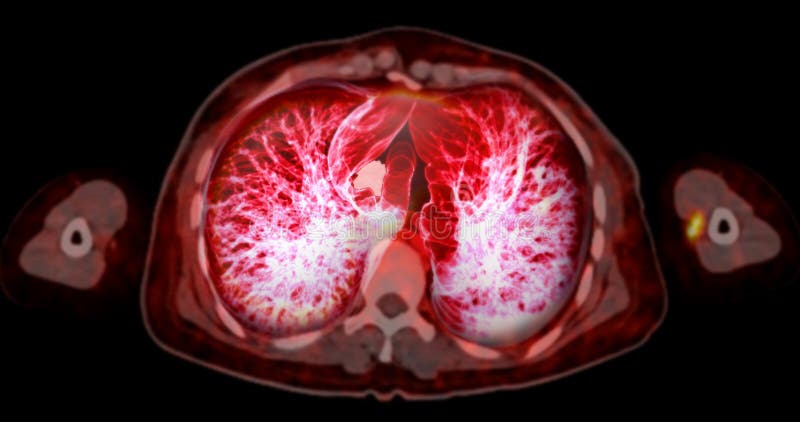 CT Chest or Lung 3d Rendering Image Showing Trachea and Lung in ...