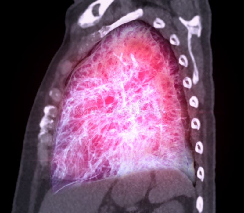 CT Chest or Lung 3d Rendering Image Showing Trachea and Lung in ...