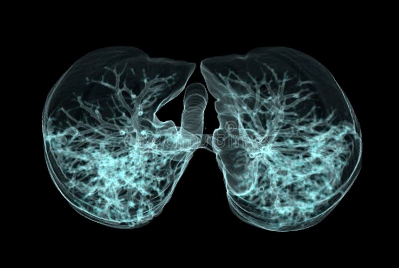 CT Chest or Lung 3d Rendering Image Showing Trachea and Lung in ...