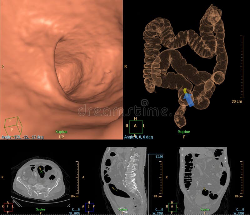 CT Colonography 3D and 2D Axial,sagittal ,coronal Plane . Stock ... CT Colonography 3D and 2D Axial,sagittal ,coronal Plane . Stock ...