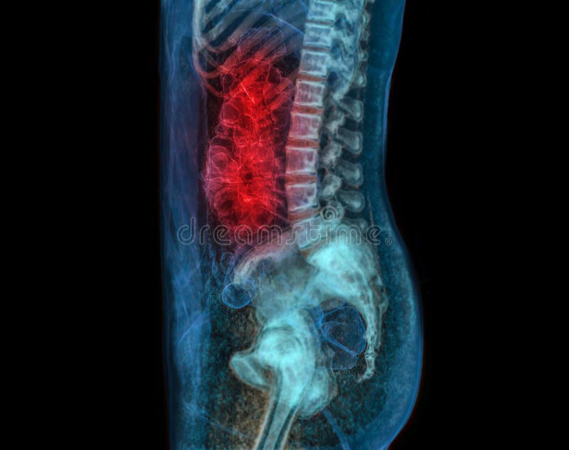 Ct Colonography Or Ct Scan Of Colon 3d Rendering Image For Screening Colorectal Cancer Check Up