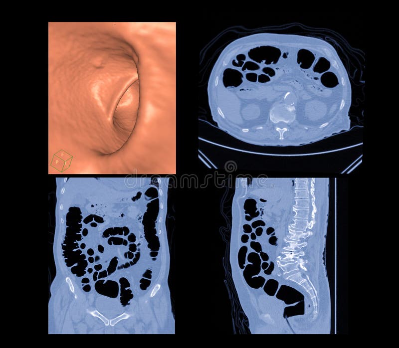 CT Colonography 3D and 2D Axial,sagittal ,coronal Plane . Stock ... CT Colonography 3D and 2D Axial,sagittal ,coronal Plane . Stock ...