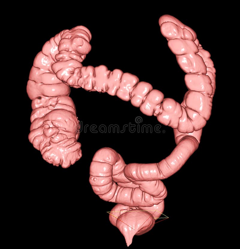 CT Colonography 3D Rendering Image Showing Colon for Screening ...