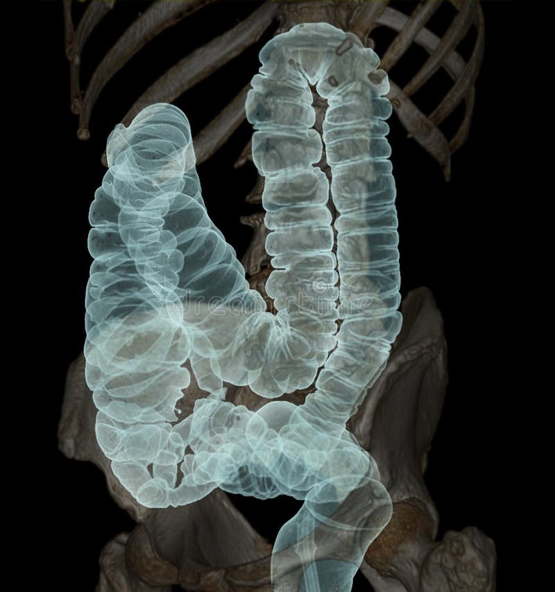 CT Colonography 3D Rendering Image Showing Colon for Screening ... CT Colonography 3D Rendering Image Showing Colon for Screening ...