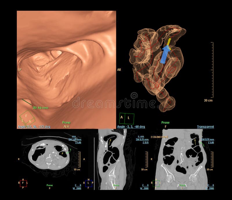 CT Colonography 3D Rendering Image Showing Colon for Screening ...