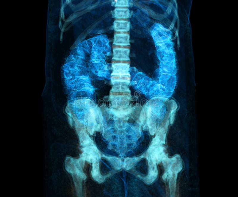 Ct Colonography Or Ct Scan Of Colon 3d Rendering Image Ap View Showing Colon For Screening