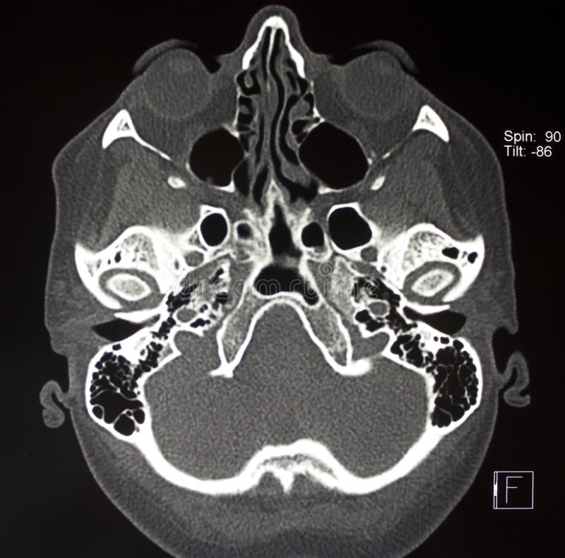 CT of cranial bones stock image. Image of illness, radiology - 9982777