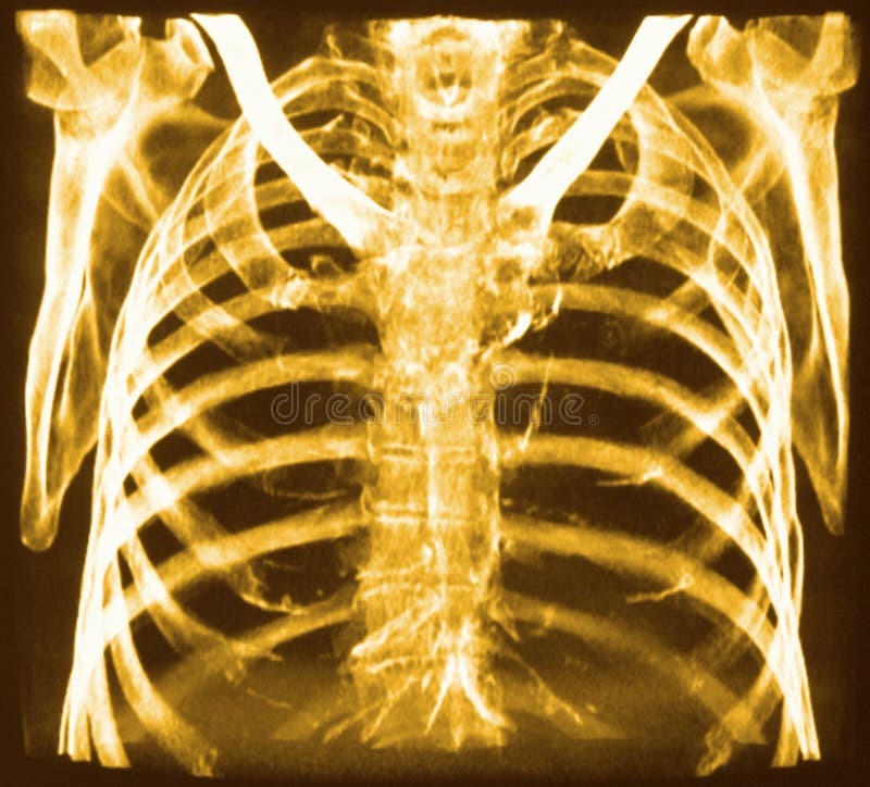 CT de los huesos del pecho imagen de archivo. Imagen de rayo - 13352445