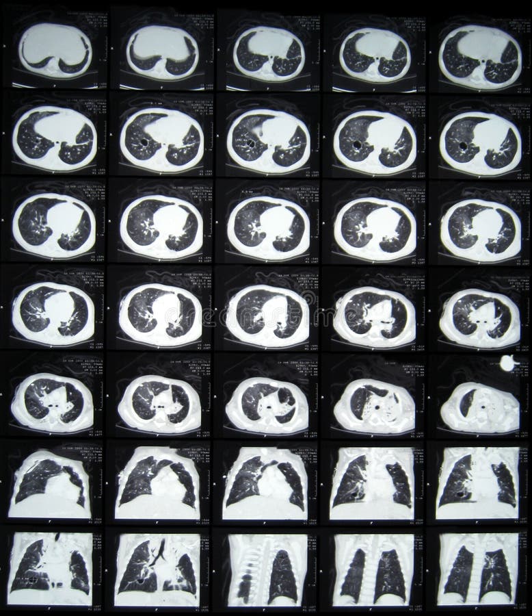 CT del tórax foto de archivo. Imagen de rayo, pecho, medicina - 8582396